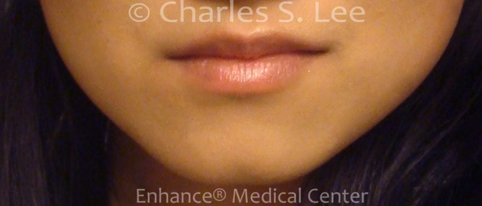 Jawline reduction (Mandibular angle reduction) | Charles S. Lee, MD