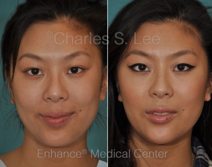 All Natural Chin Augmentation | Charles S. Lee, MD